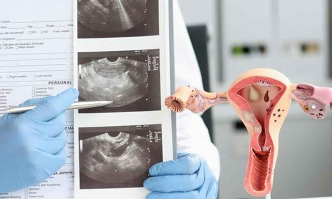 What is Cervical Polyps? Causes, Symptoms and Treatment