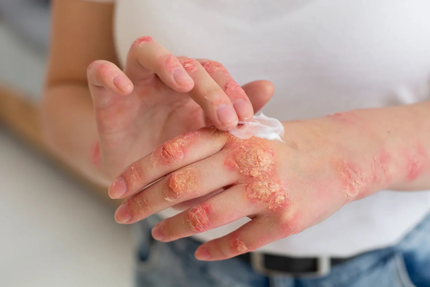 Plaque Psoriasis: Causes, Treatments and Lifestyle Tips